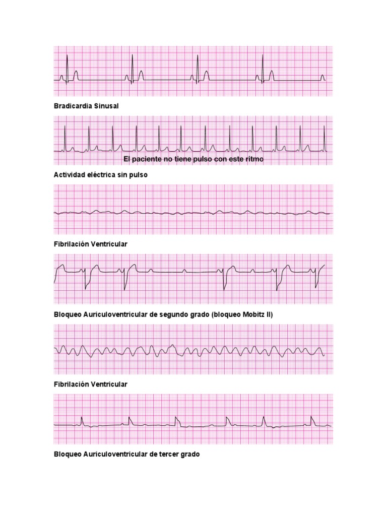 Ecg Acls | PDF