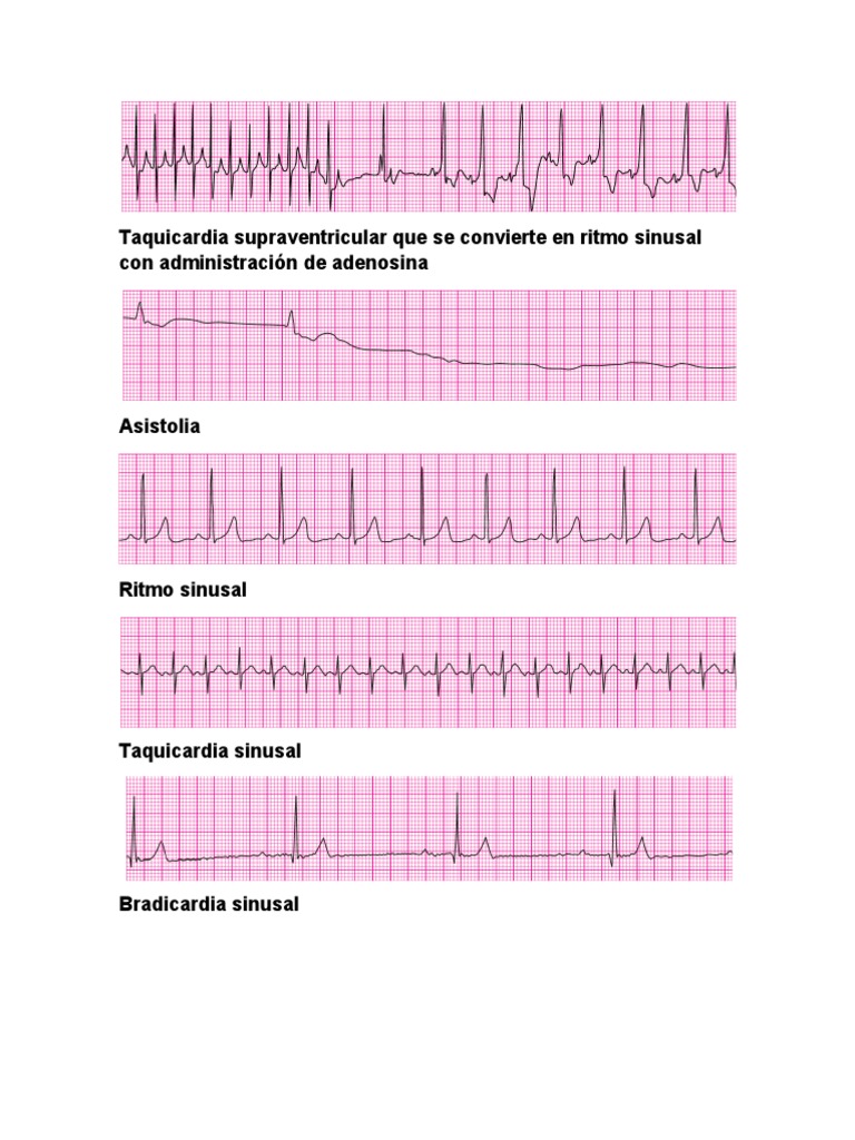 PALS Trazos EKG | PDF