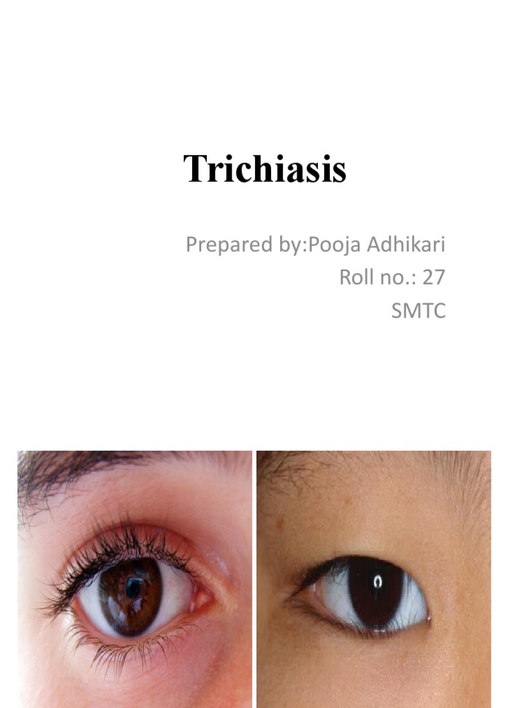 Trichiasis | PDF | Pain | Surgery
