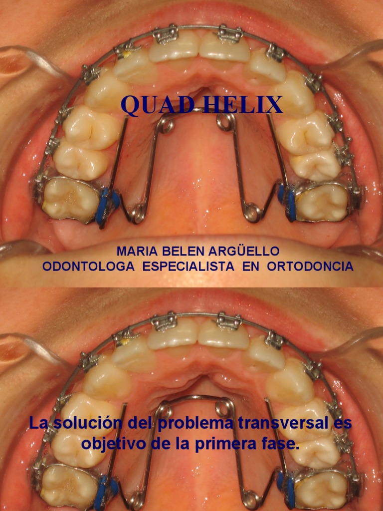 Quad Helix | PDF | Ortodoncia | Salud y bienestar