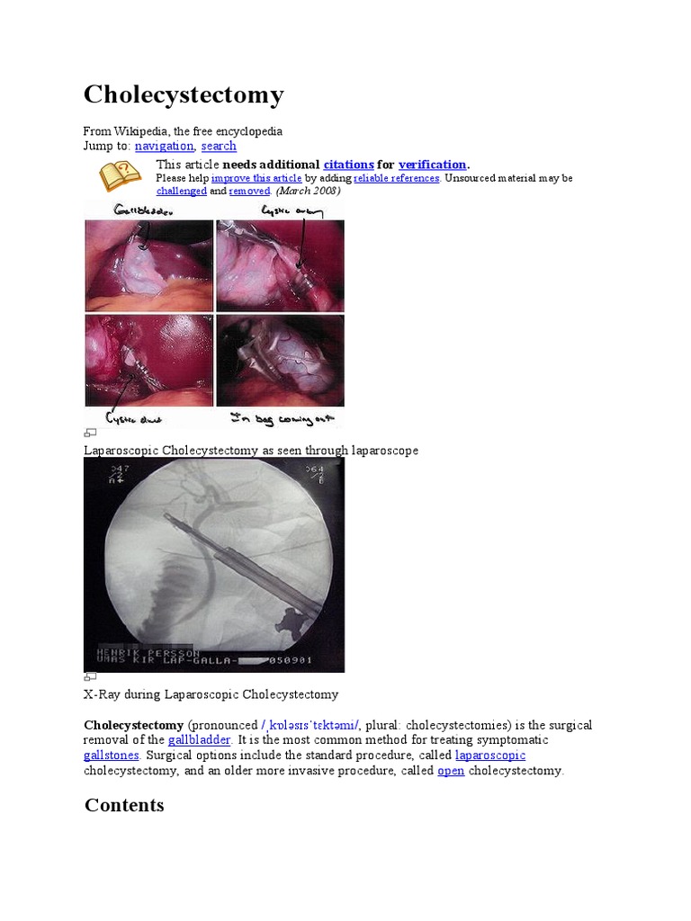 Laparoscopic Cholecystectomy Overview | PDF | Gallbladder | Surgery