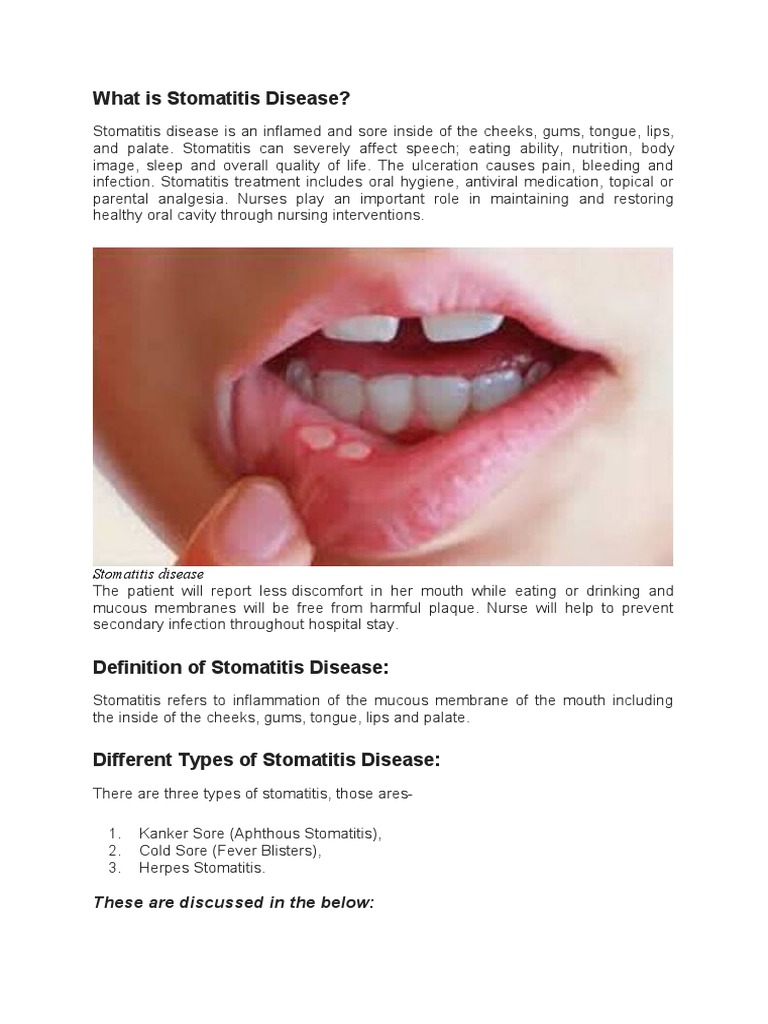 Stomatitis Disease Overview & Treatment | PDF | Herpes Simplex ...