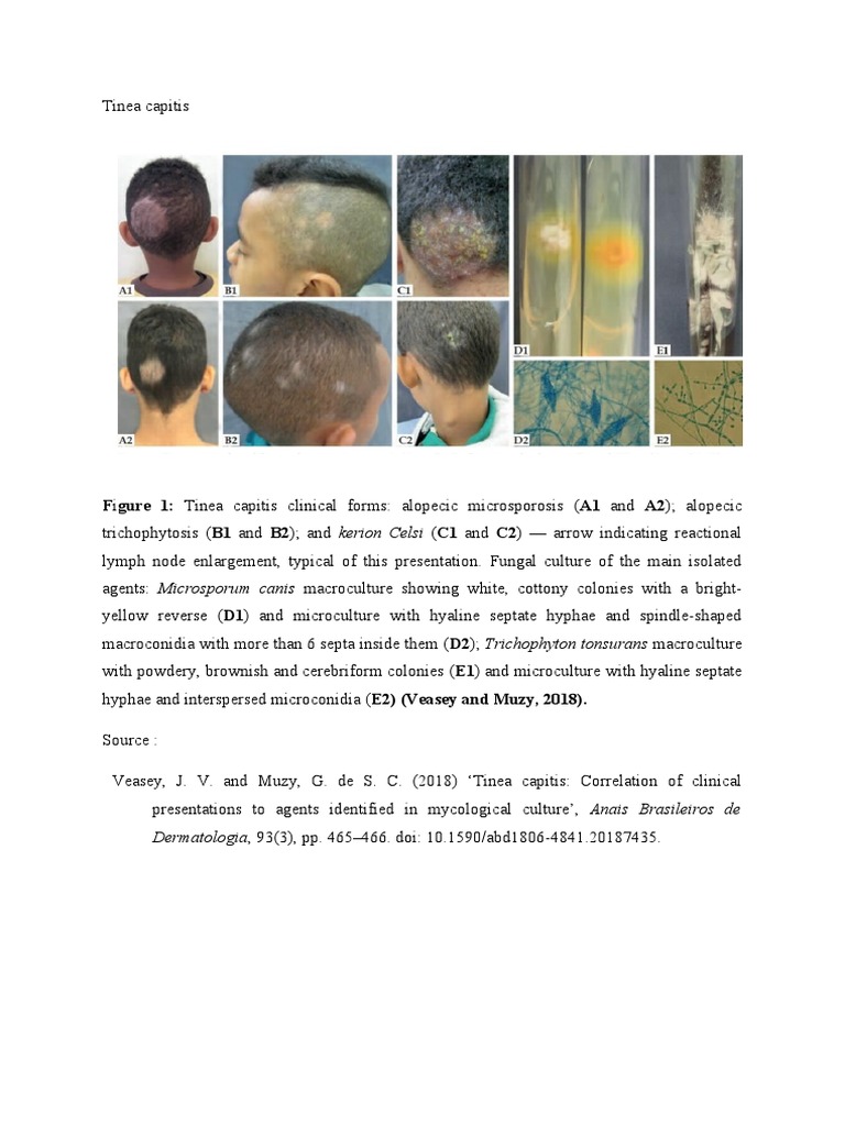 Figure 1: Tinea Capitis Clinical Forms: Alopecic Microsporosis (A1 and ...