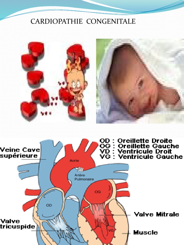 C22 - Cardiopathies Congénitales | PDF | Cardiopathie congénitale | Système circulatoire
