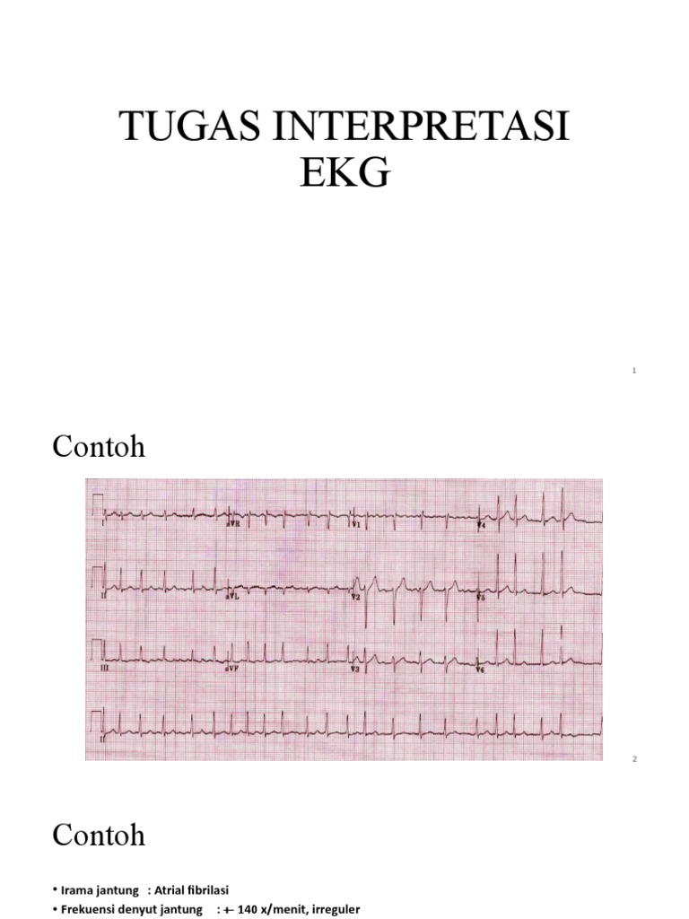 LEMBARAN PENUGASAN Interpretasi Gambaran EKG PDF