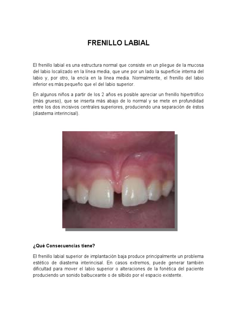Frenillo Labial | PDF | Dentadura postiza | Especialidades Medicas