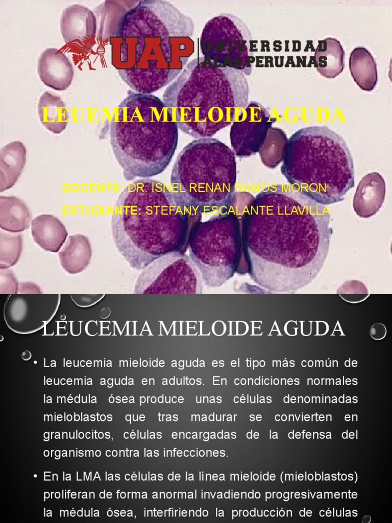 Leucemia Mieloide Aguda | PDF | Leucemia | Anatomía