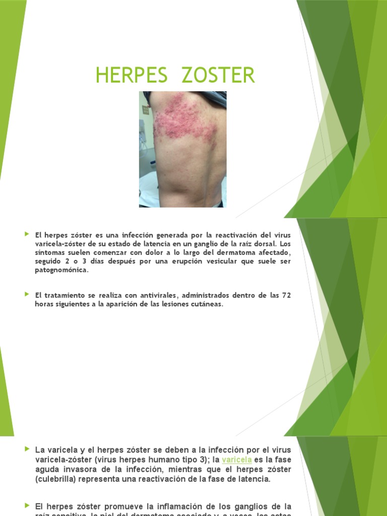 Herpes Zoster | PDF | Herpes Simple | Microbiología