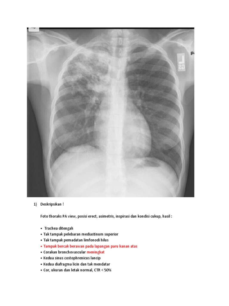 Temuan Radiologi Hilus Paru dan TB | PDF