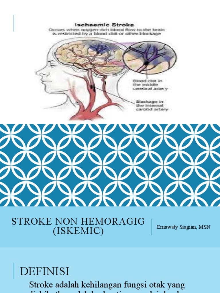 Stroke Iskemik | PDF