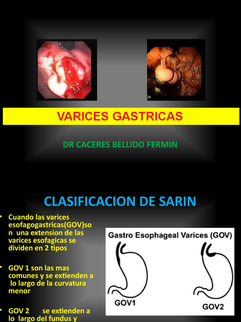 Varices Gastricas | PDF | Sistema cardiovascular | Especialidades Medicas