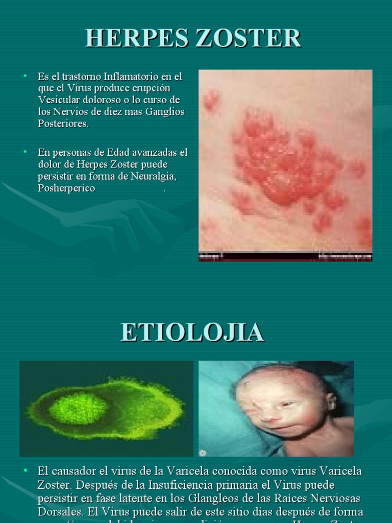 Diapositivas Herpes Zoster | PDF | Bienestar | Medicina