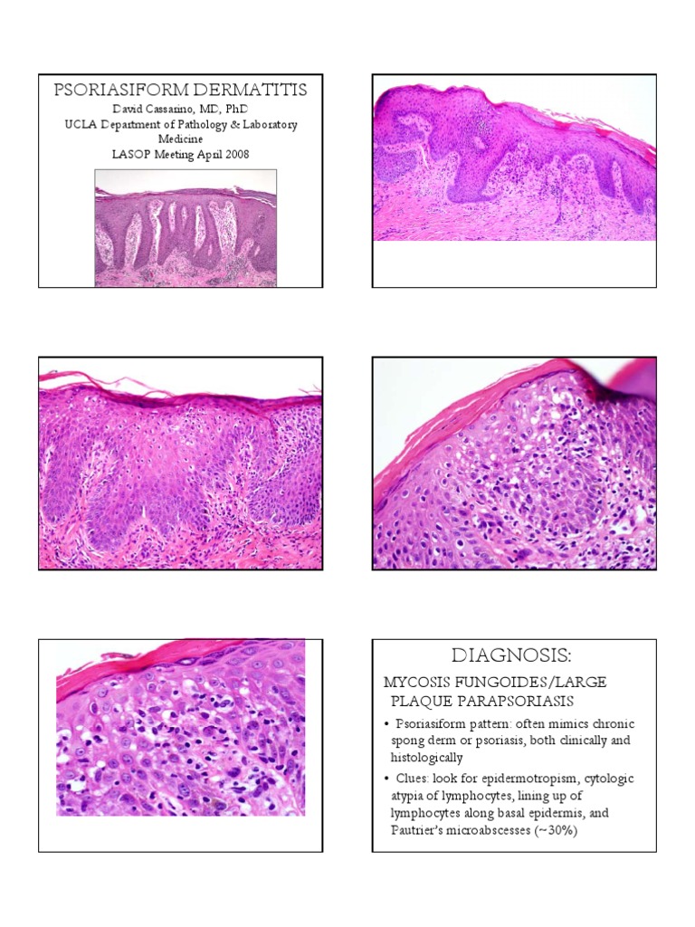 2008 04 Lecture 2 Psoriasiform Dermatitis Cassarino | Psoriasis ...