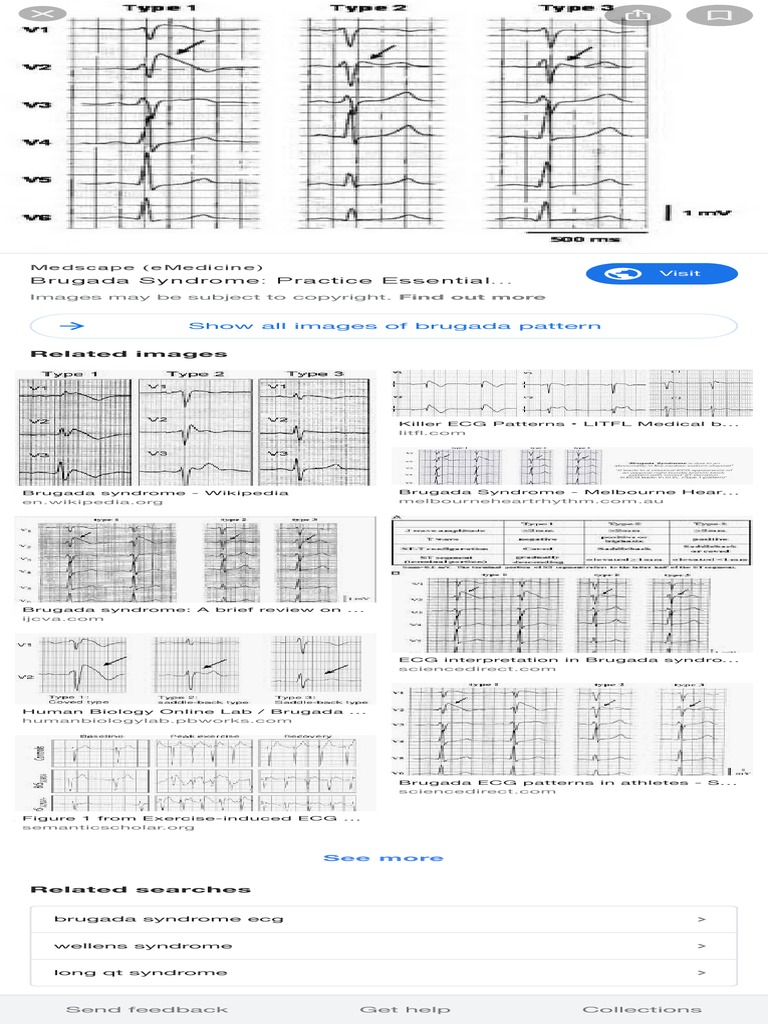 Brugada Pattern | PDF | Electrocardiography | Internal Medicine