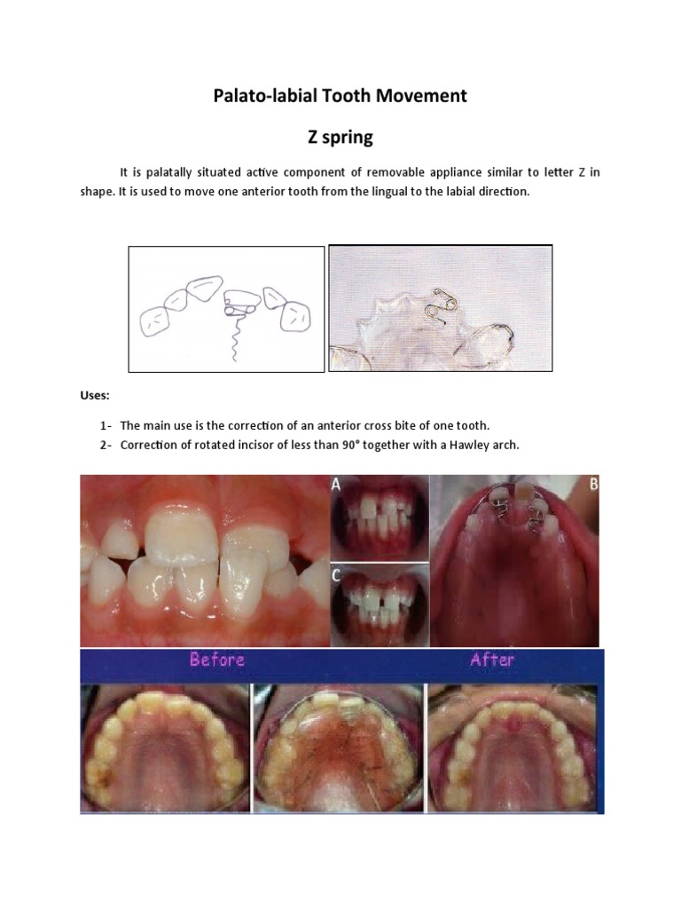 Palato-Labial Tooth Movement Z Spring: Uses | PDF | Dentistry ...