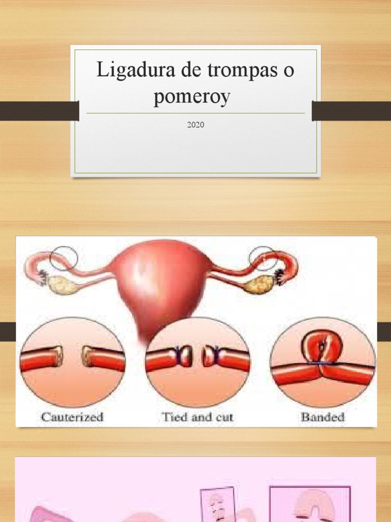 Ligadura de Trompas | PDF