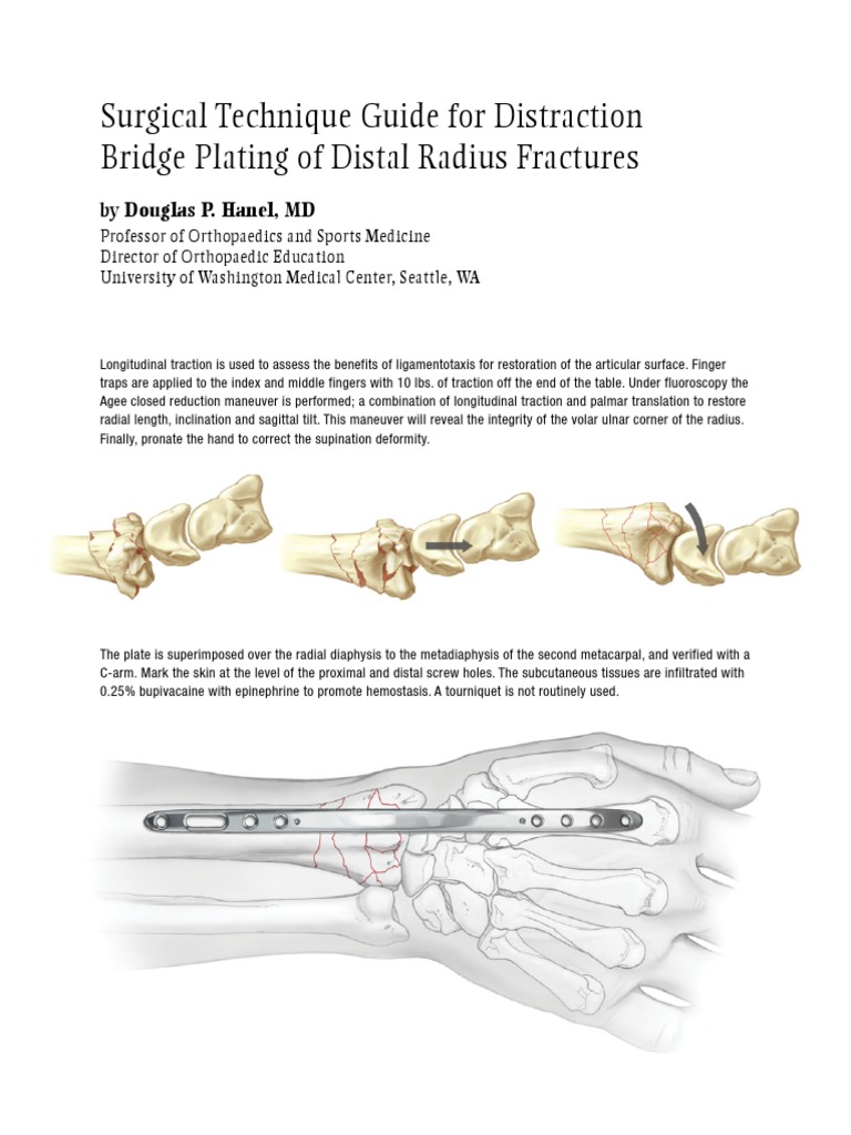 Distraction Bridge Plating for Radius Fractures | PDF | Hand | Thumb
