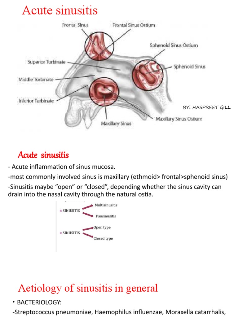Acute Sinusitis | PDF