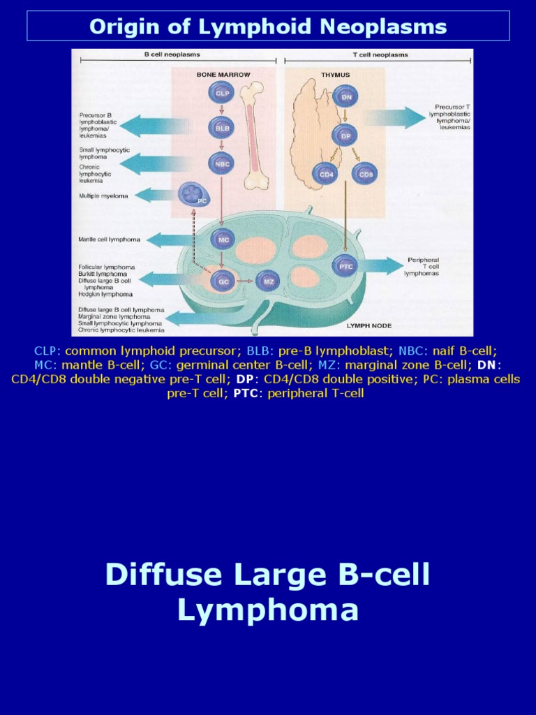 Origin of Lymphoid Neoplasms: CLP: BLB: NBC: MC: GC: MZ | PDF | B Cell | Lymphoma