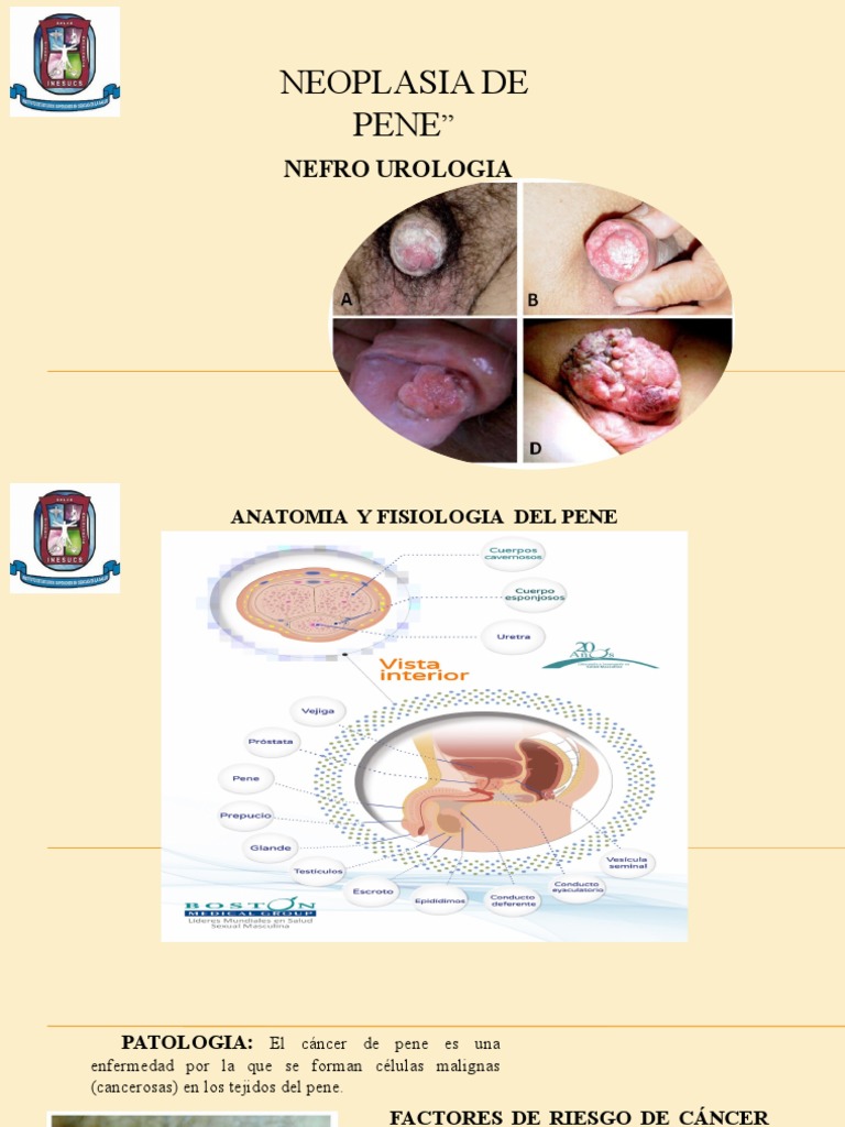 Nefro Urologia Neoplasia de Pene | PDF | Cáncer | Especialidades Medicas