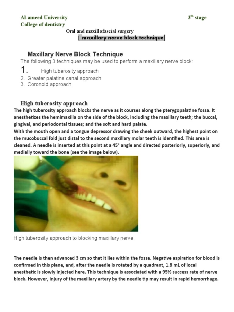 Maxillary Nerve Block Technique