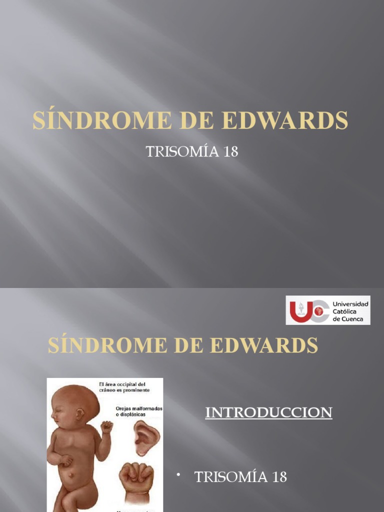 Síndrome de Edwards: Trisomía 18 | PDF | Epidemiología | Genética