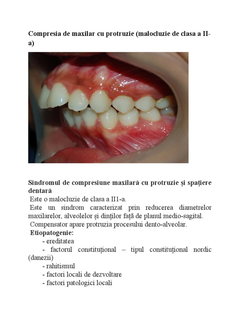 Compresia de Maxilor Cu Protruzie | PDF