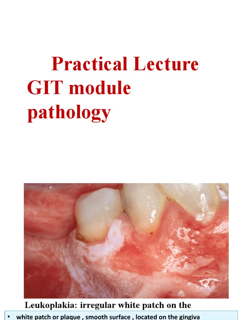 Practical Lecture GIT Module Pathology | Download Free PDF | Esophagus | Adenocarcinoma
