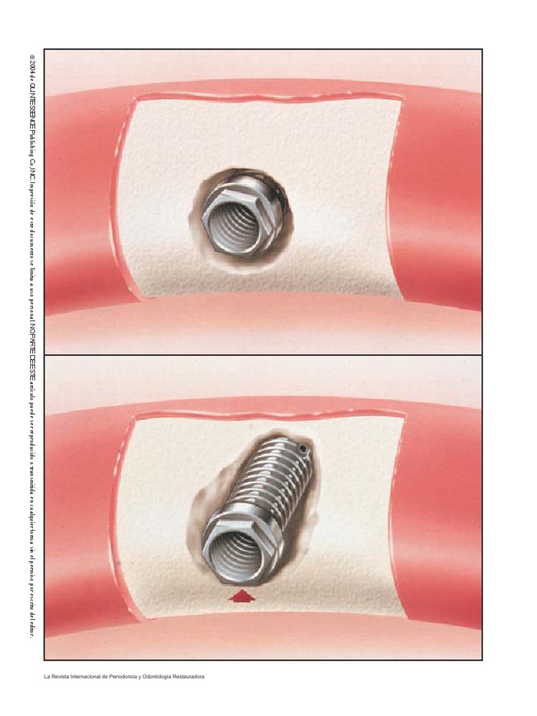 Clasificacion de Defectos Oseos Adyacentes A Implantes - En.es | PDF ...