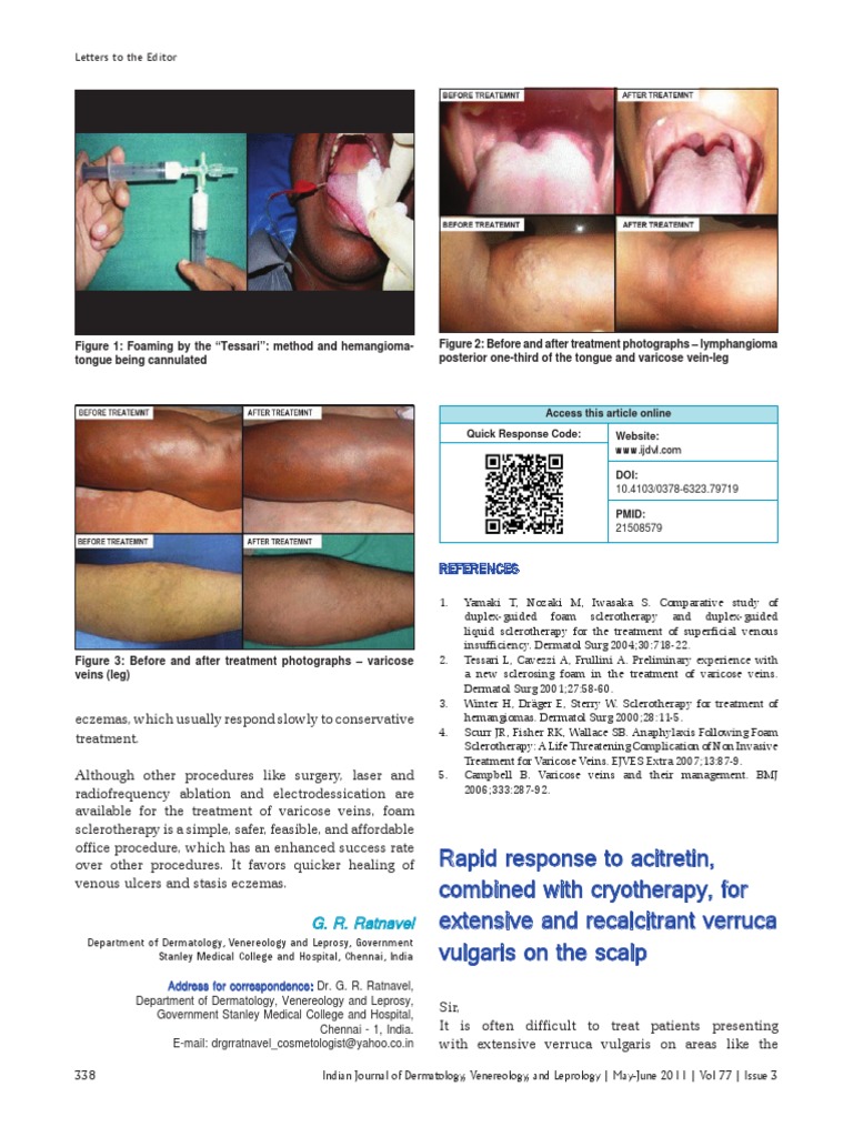 Rapid Response To Acitretin Combined With Cryotherapy For Extensive and ...