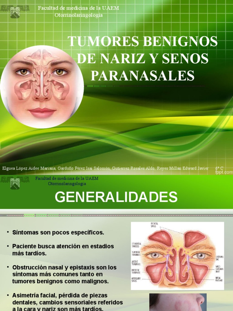 Tumores Benignos de Nariz Y Senos Paranasales | PDF | Otorrinolaringología | Anatomía de los ...