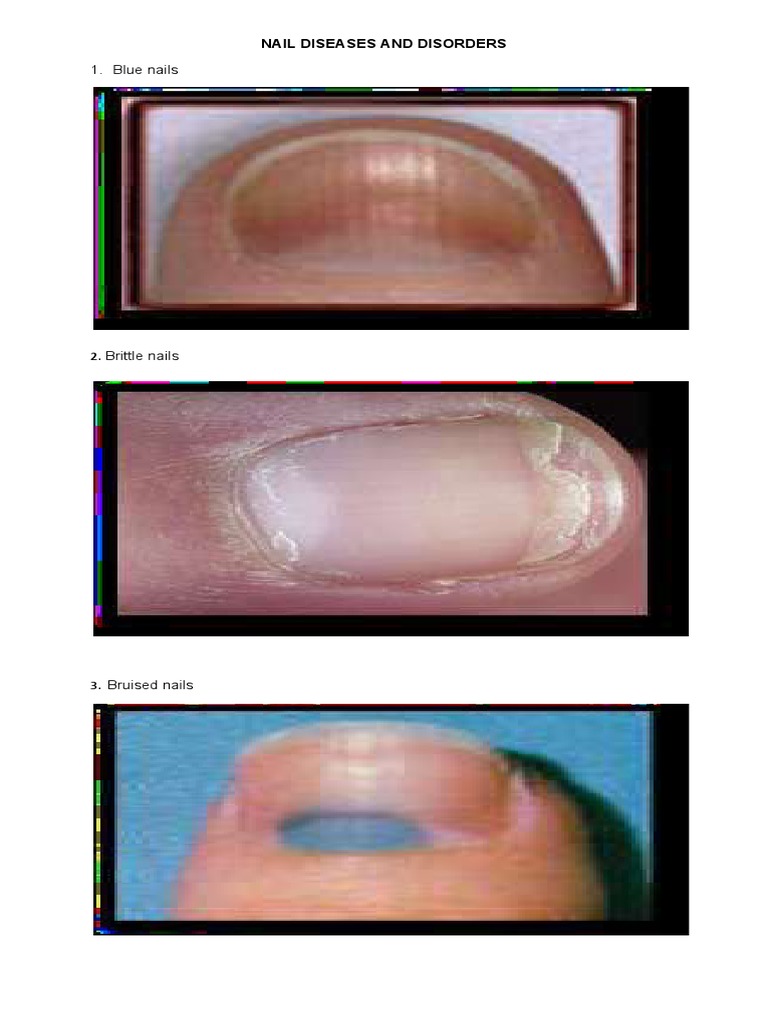 Nail Diseases and Disorders | PDF