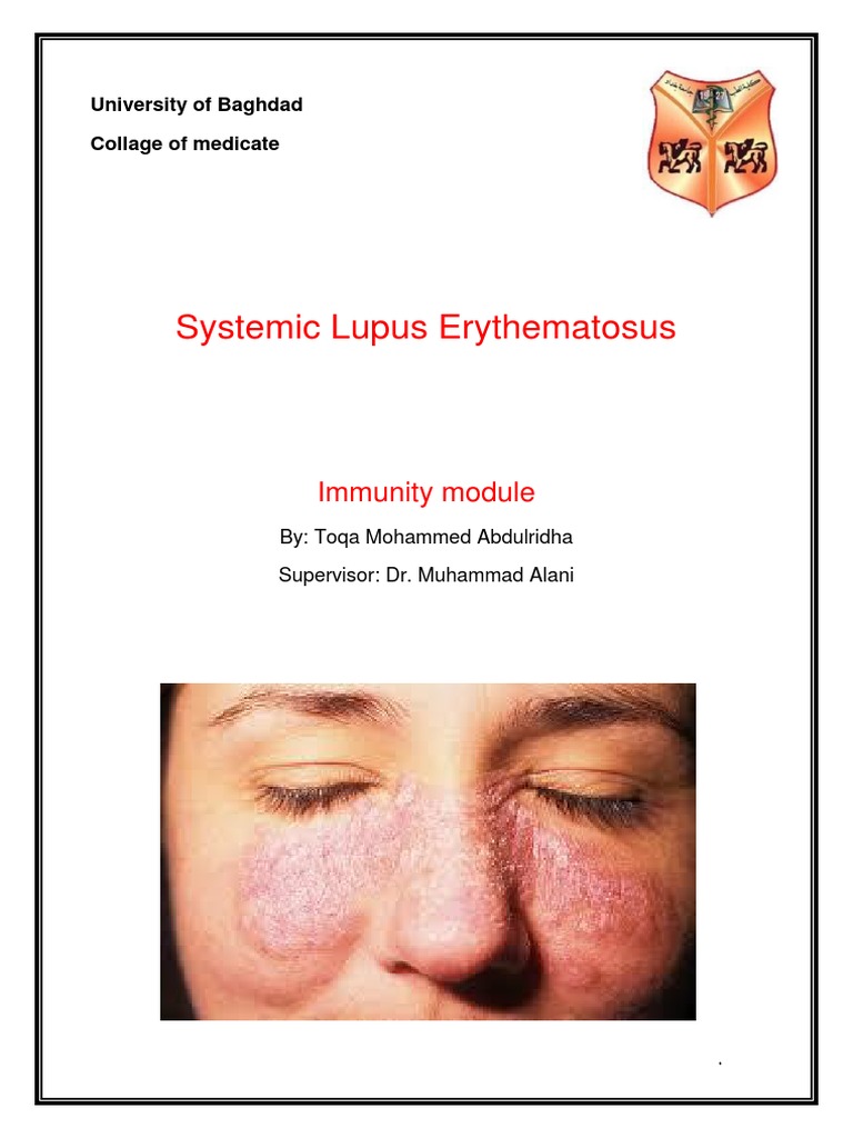 Systemic Lupus Erythematosus - Immunity PDF | PDF | Systemic Lupus ...