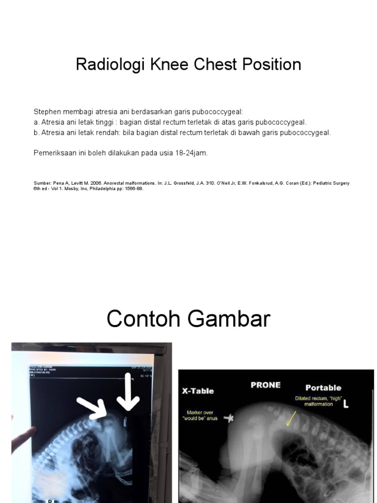 Knee Chest Position | PDF