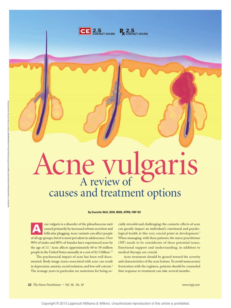 Acne Vulgaris A Review of Causes and Treatment.6 | PDF | Clinical ...