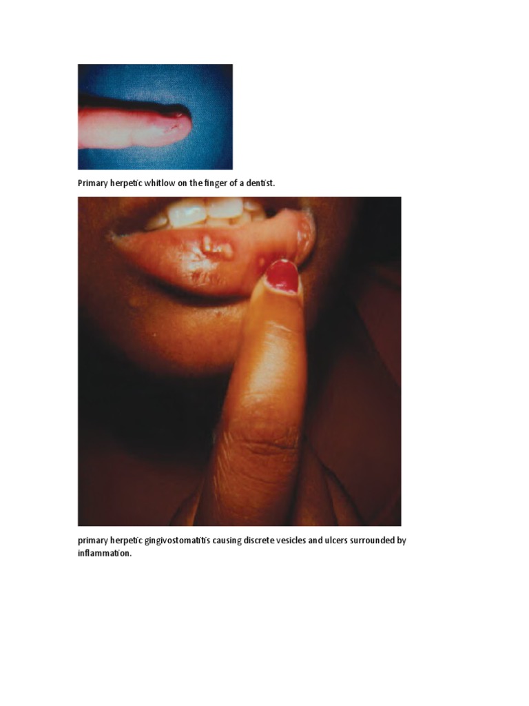 Patho Slides. 1 | PDF | Herpes Simplex | Skin