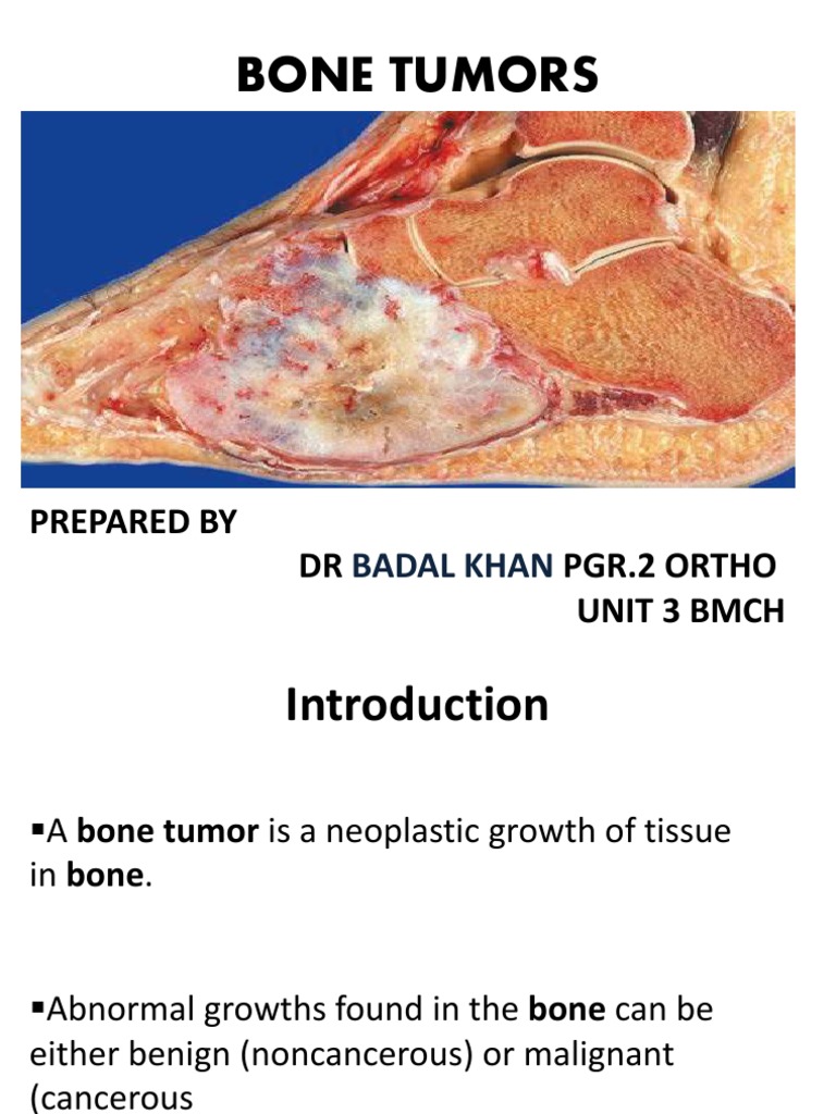 Bone Tumors: Prepared by DR Pgr.2 Ortho Unit 3 BMCH | PDF | Neoplasms ...