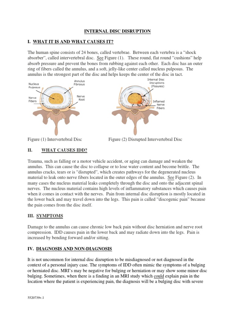 Internal Disc Disruption Article | PDF | Nervous System | Human Anatomy