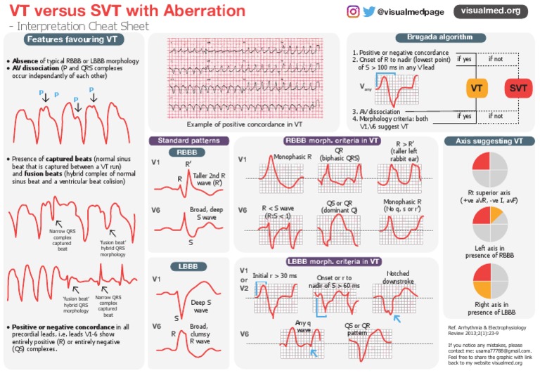 Interpretation Cheat Sheet: VT SVT | PDF | Internal Medicine | Physiology