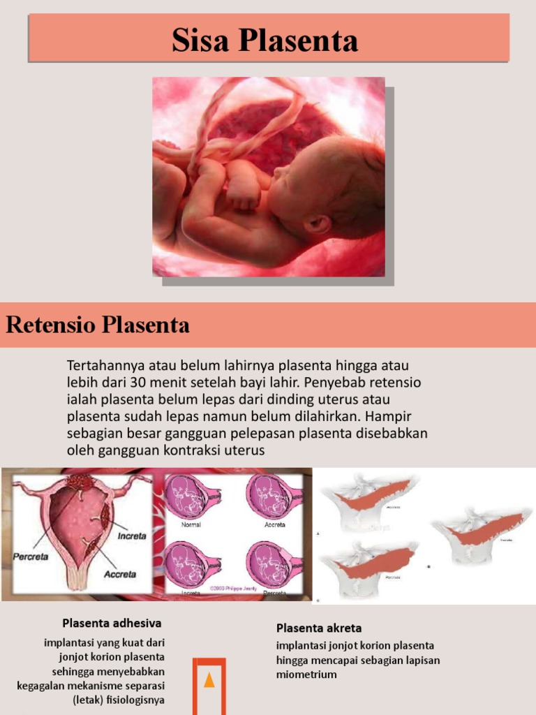 Sisa Plasenta | PDF
