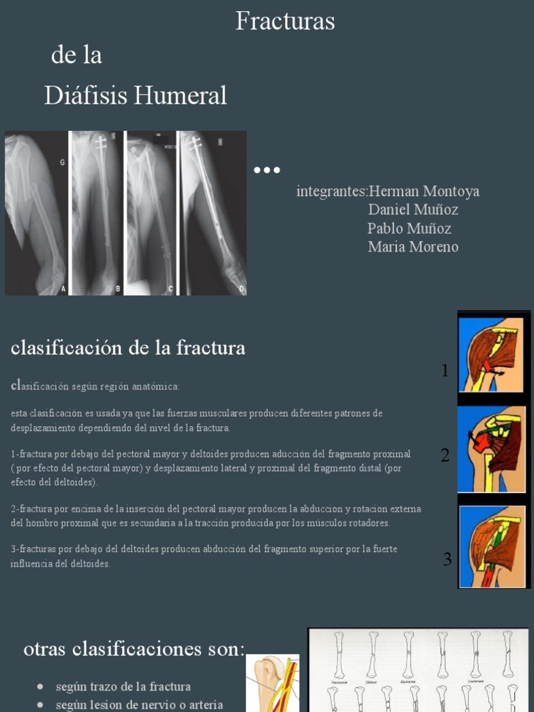 Trauma FX Diafisis Humeral | PDF | Hombro | Codo