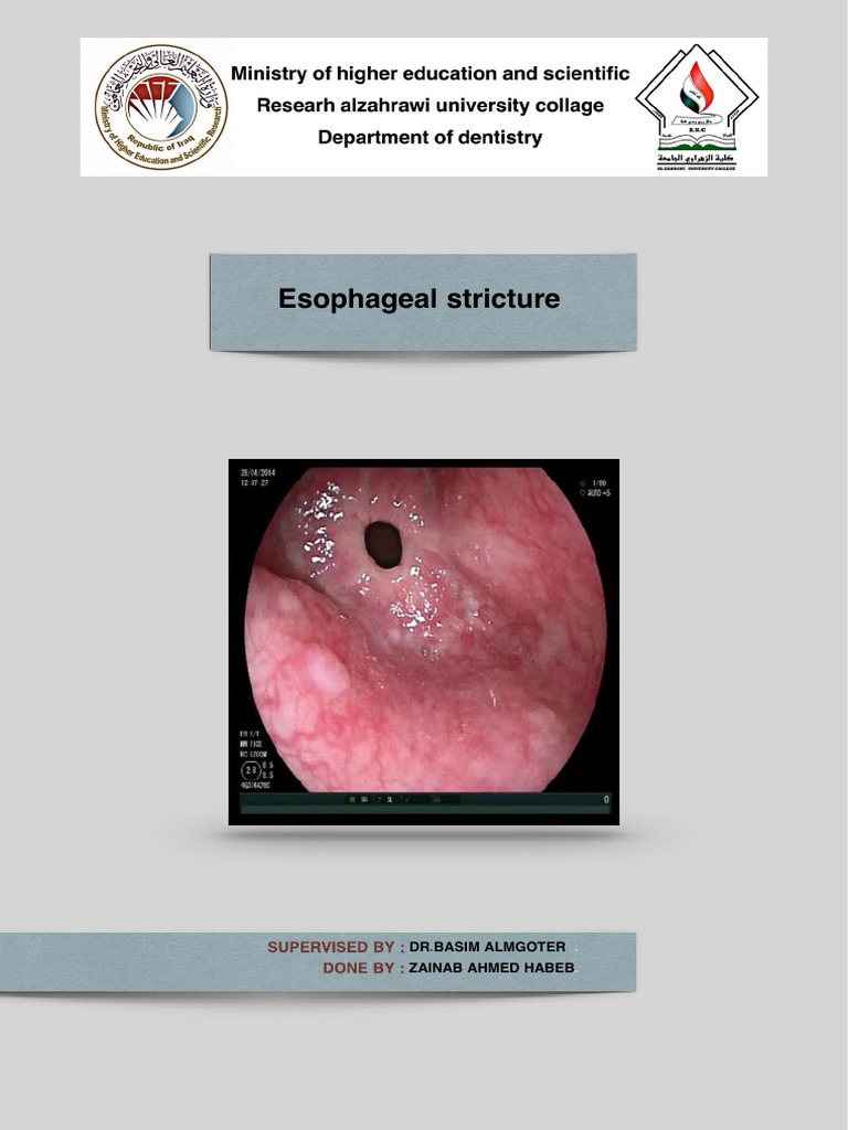 Esophageal Stricture | PDF | Esophagus | Gastroesophageal Reflux Disease