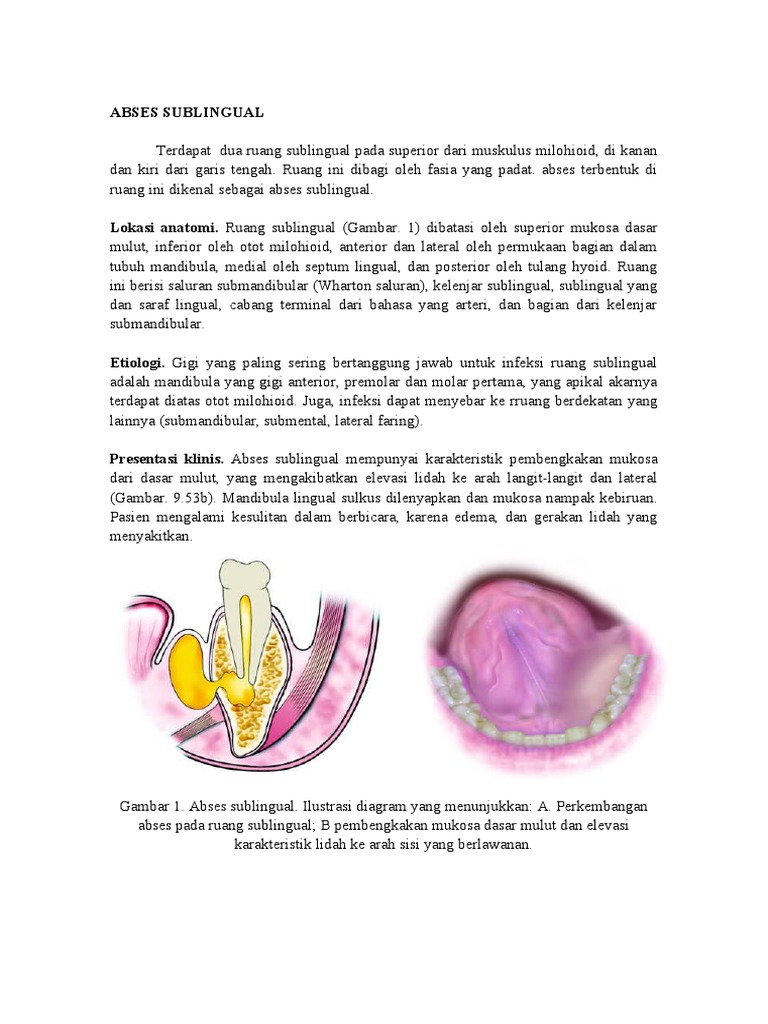 Abses Sublingual: Penyebab dan Pengobatan | PDF