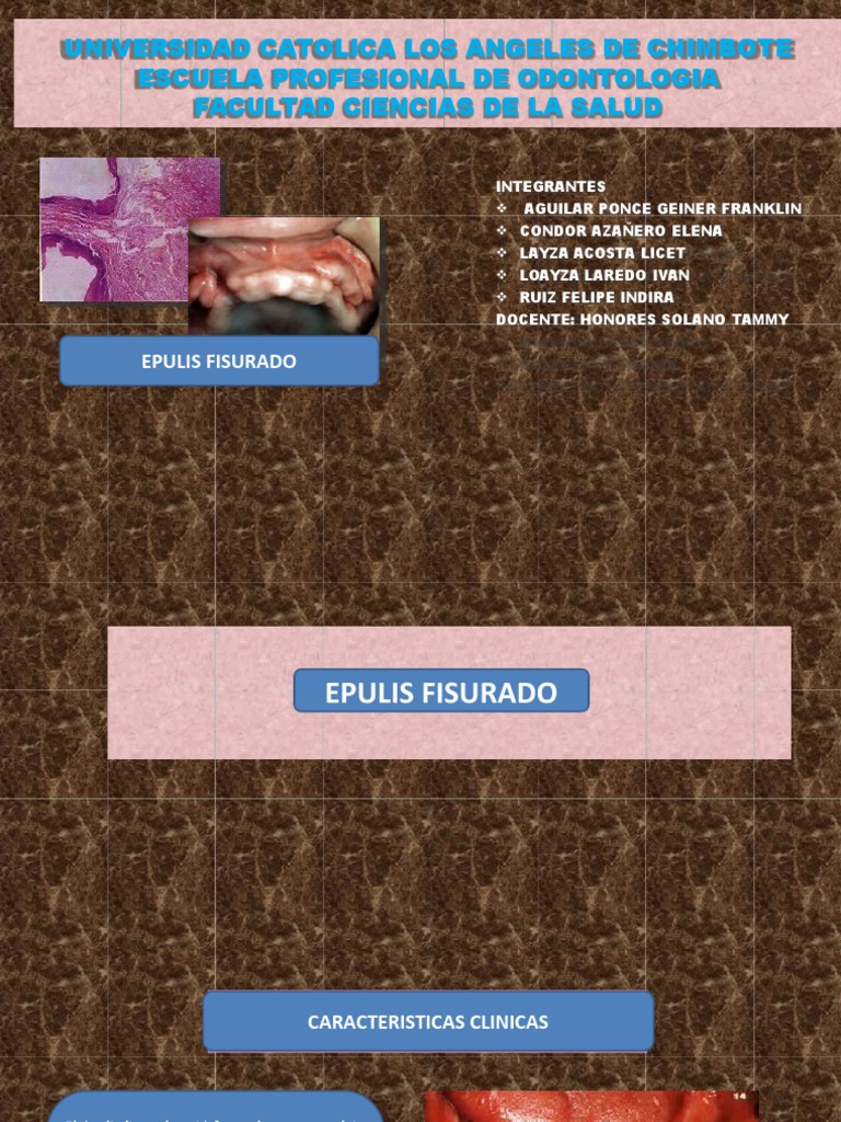 Epulis Fisurado | PDF