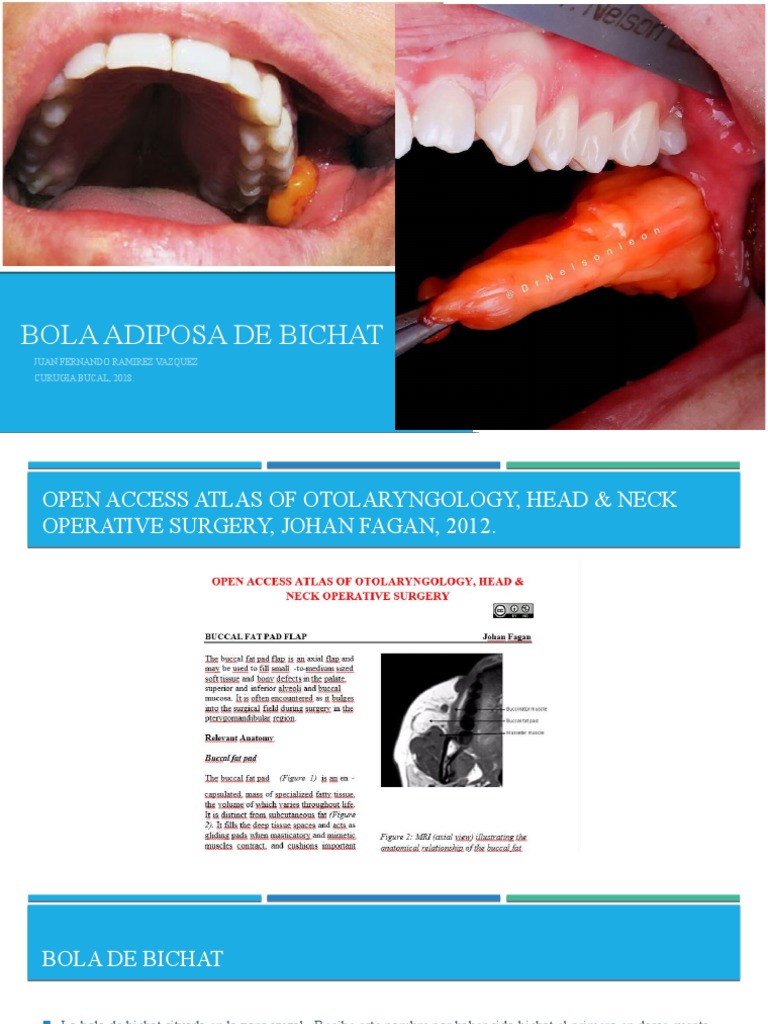 Bola Adiposa de Bichat FR | PDF | Anatomía humana | Cabeza y cuello humanos