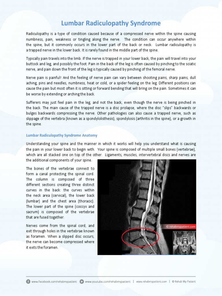 Lumbar Radiculopathy Syndrome | PDF | Vertebral Column | Spinal Cord