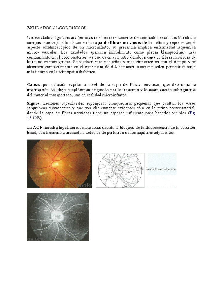 Exudados Algodonosos en Retina | PDF | Capilar | Isquemia