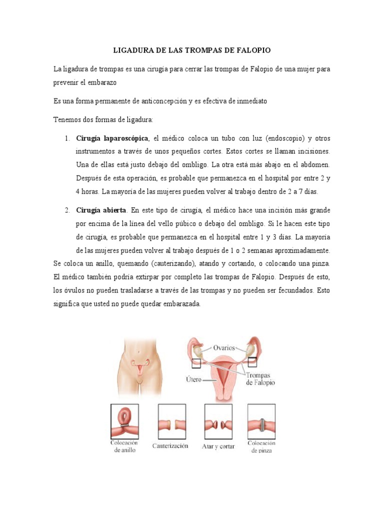 Ligadura de Trompas: Procedimiento y Efectos | PDF | El embarazo ...