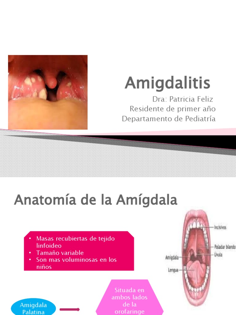 Amigdalitis: Presentación, diagnóstico y tratamiento de esta patología ...