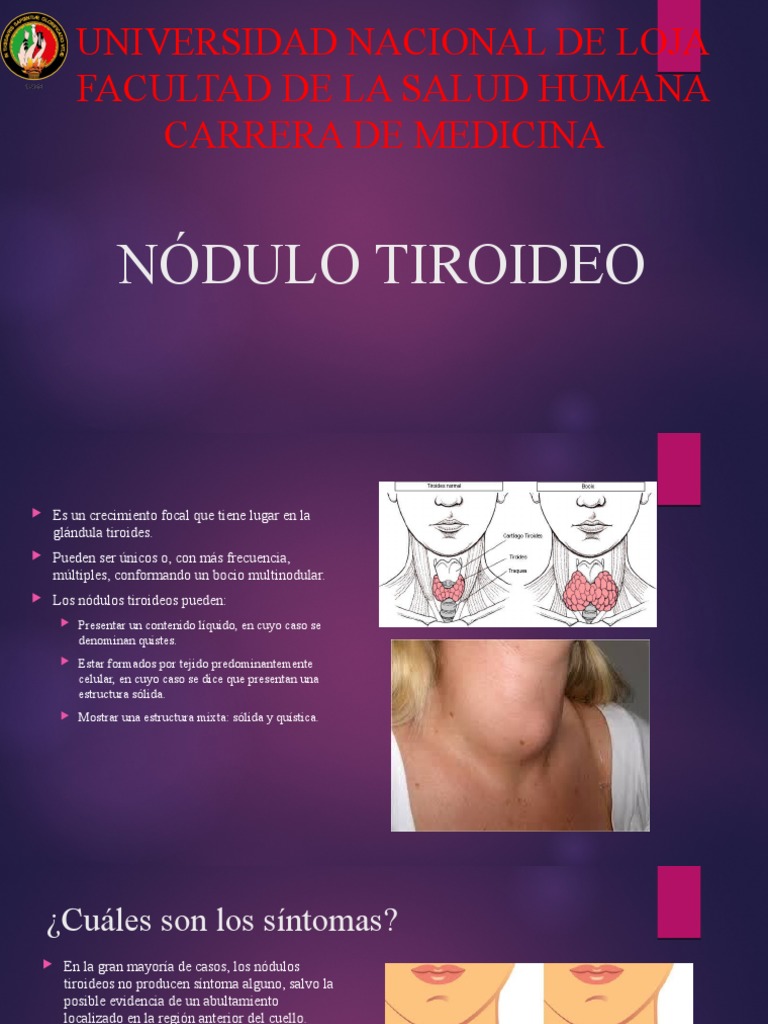 Nódulo Tiroideo | PDF | Tiroides | Glándulas